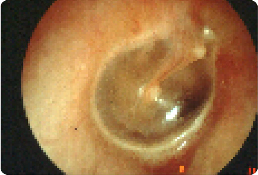 Gromments for Glue Ear - Dr Murali Mahadevan - ENT Surgeon