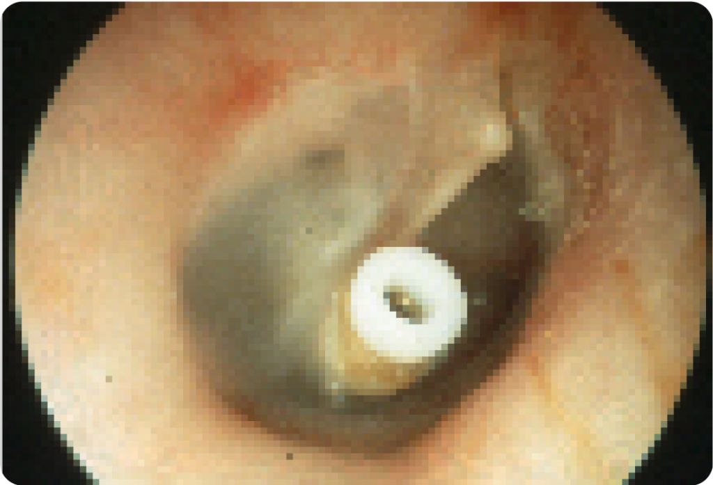 Gromments for Glue Ear - Dr Murali Mahadevan - ENT Surgeon