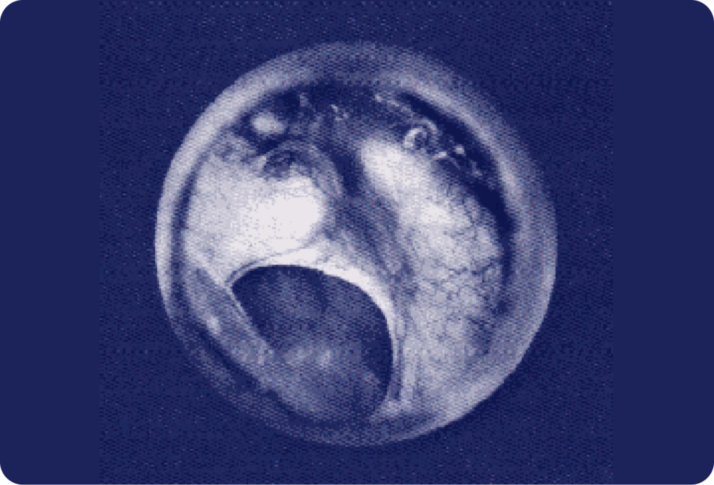 Perforated eardrum - Dr Murali Mahadevan - ENT Surgeon