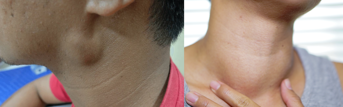 Branchial Cysts - Dr Murali Mahadevan - ENT Surgeon