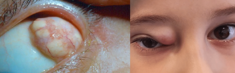 Dermoid Cysts - Dr Murali Mahadevan - ENT Surgeon