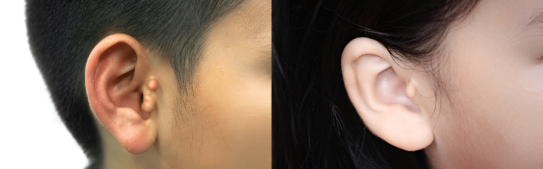 Ear Tags and Nodules - Dr Murali Mahadevan - ENT Surgeon