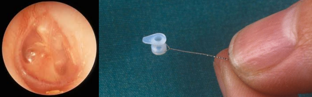 Gromments For Glue Ear Dr Murali Mahadevan ENT Surgeon Gromments For Glue Ear Dr Murali Mahadevan ENT Surgeon