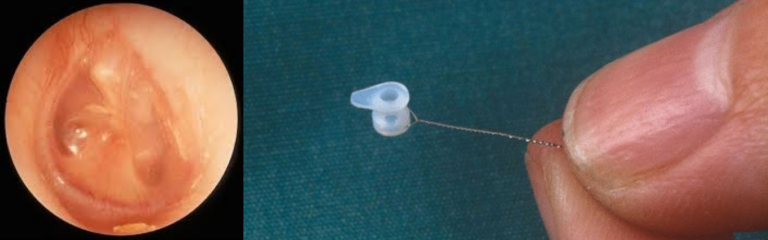 Gromments for Glue Ear - Dr Murali Mahadevan - ENT Surgeon