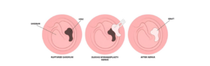 Perforated eardrum - Dr Murali Mahadevan - ENT Surgeon