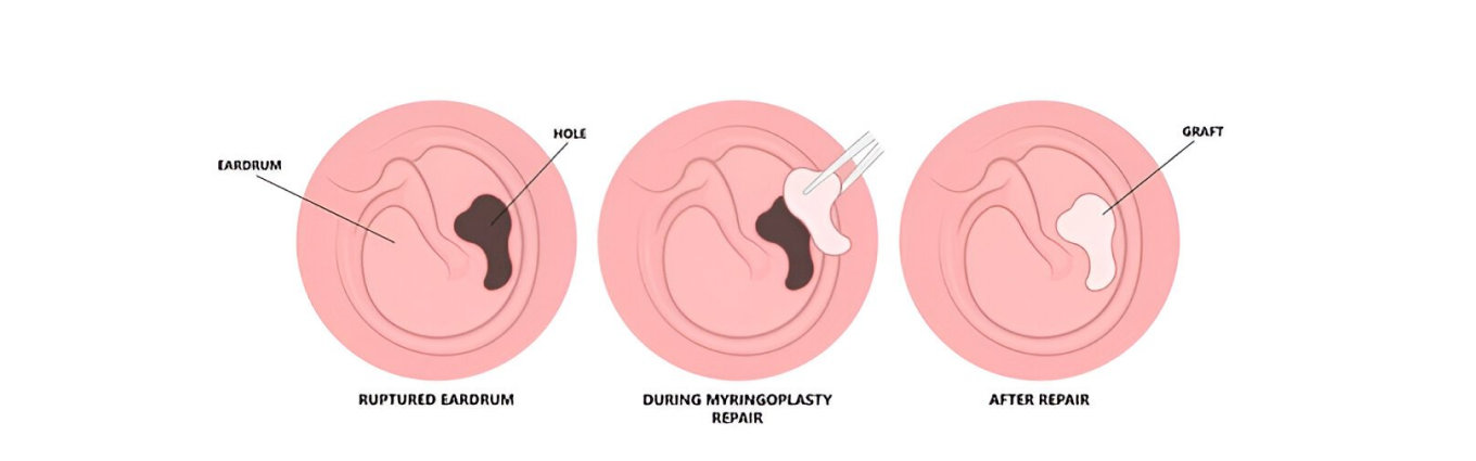 Perforated eardrum - Dr Murali Mahadevan - ENT Surgeon