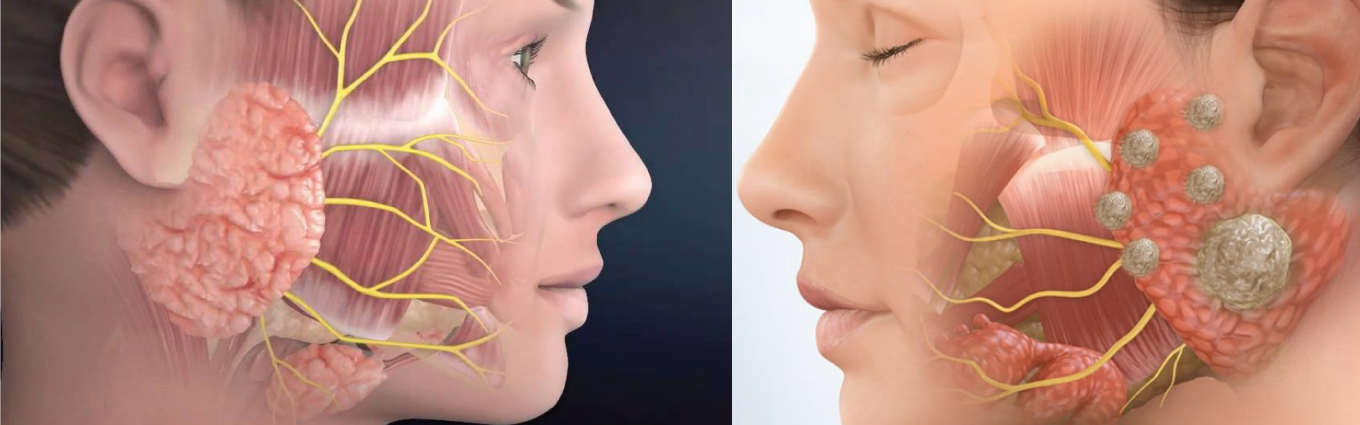 Salivary gland masses & tumours - Paediatric ENT Specialist