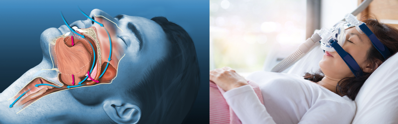 Surgery for Snoring and Sleep Apnoea - Dr Murali Mahadevan - ENT Surgeon