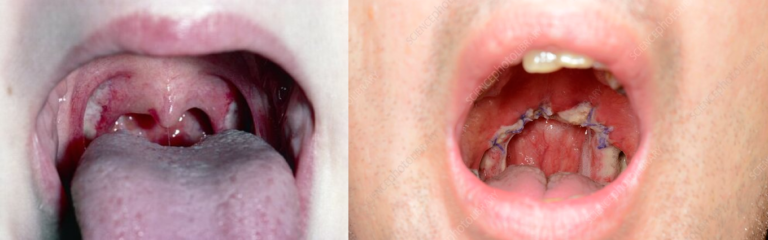 Tonsillectomy - Dr Murali Mahadevan - ENT Surgeon
